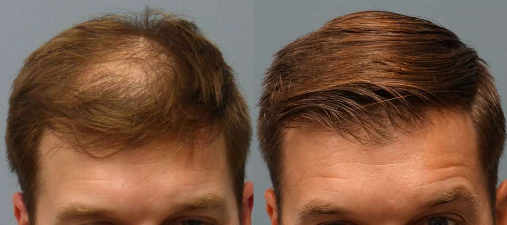 Neograft Hair Restoration Hair Restoration Savannah 1 Hair Clinic